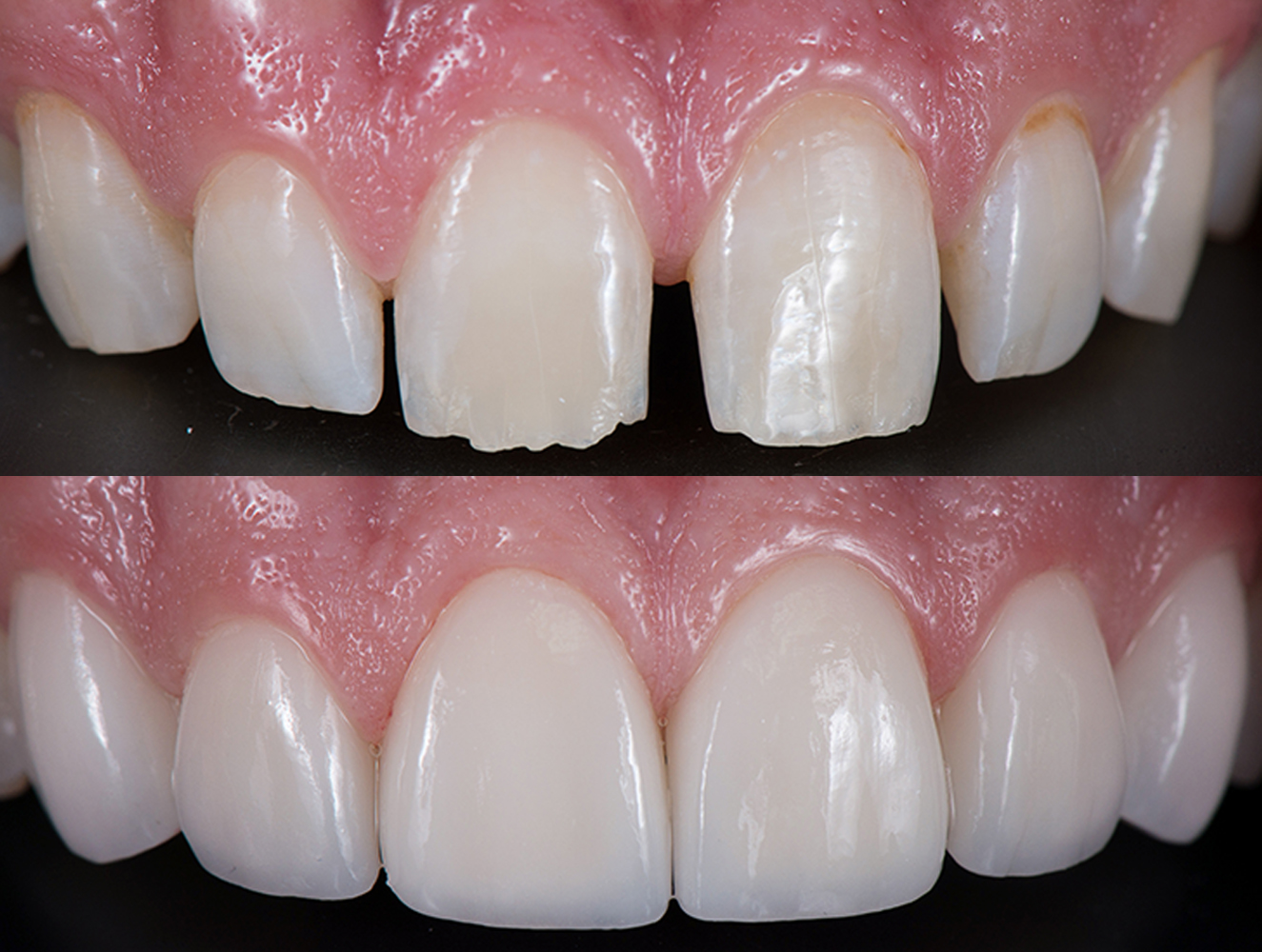 Veneers - Heswall, Wirral | The White House Dental